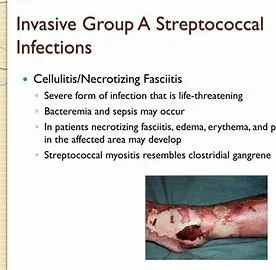 5 Shocking Realities of Invasive Strep A: Unveiling the Silent Threat ...